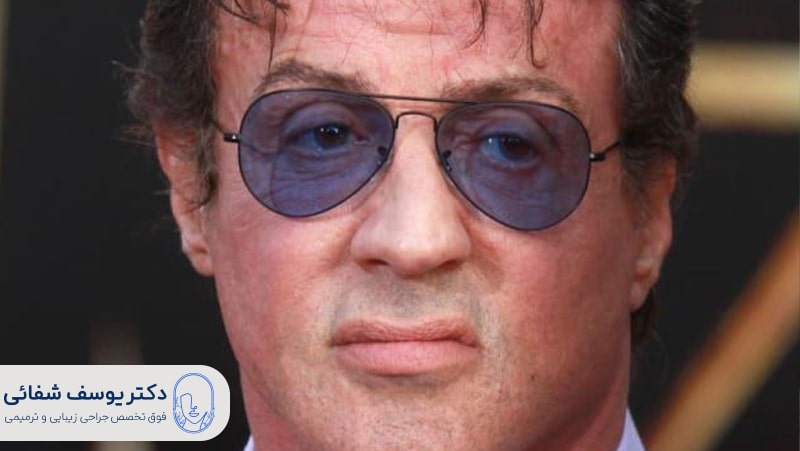 فلج بلز (Bell’s Palsy) چیست؟ علائم و جدیدترین روش‌های درمان